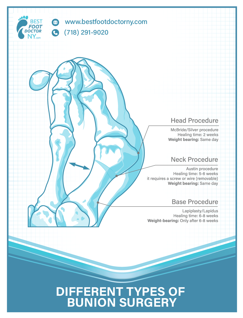 What Is a Bunion? A Bunion Guide With Treatment Options
