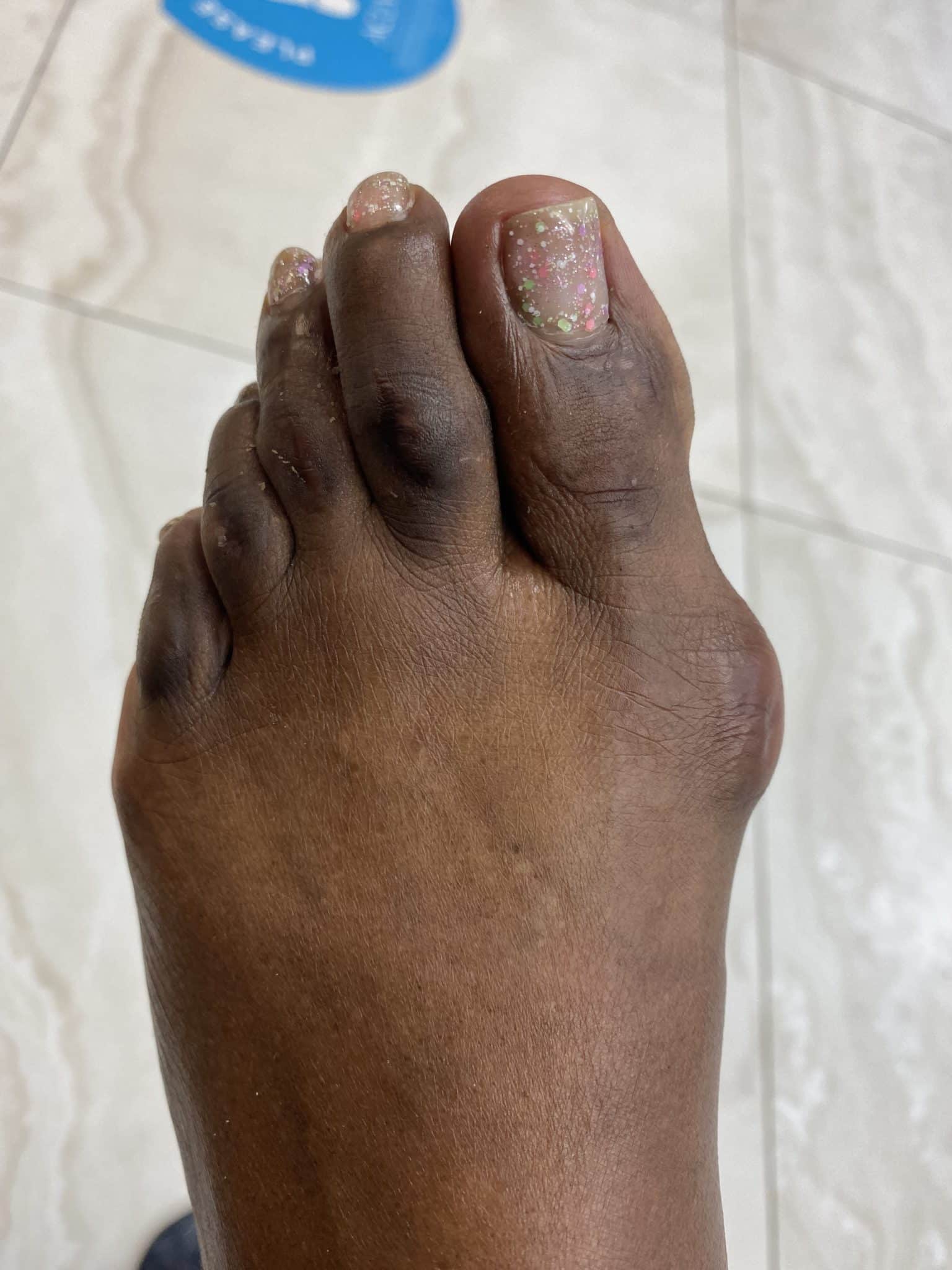 What Is a Bunion? A Guide to Bunions, What They Are and How to Treat ...