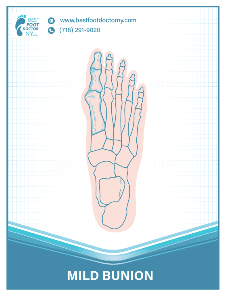 What Is a Bunion? A Bunion Guide With Treatment Options