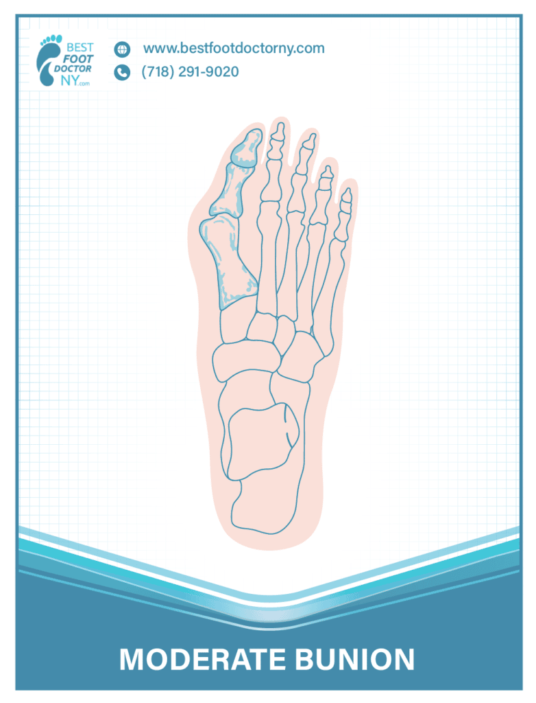 What Is a Bunion? A Bunion Guide With Treatment Options