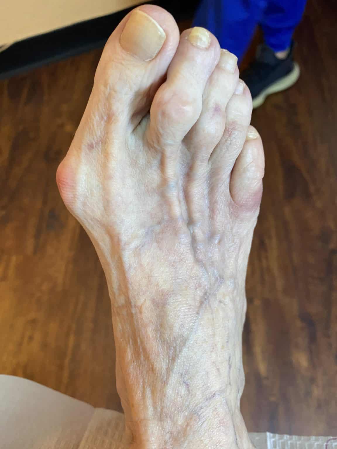 What Is a Bunion? A Bunion Guide With Treatment Options