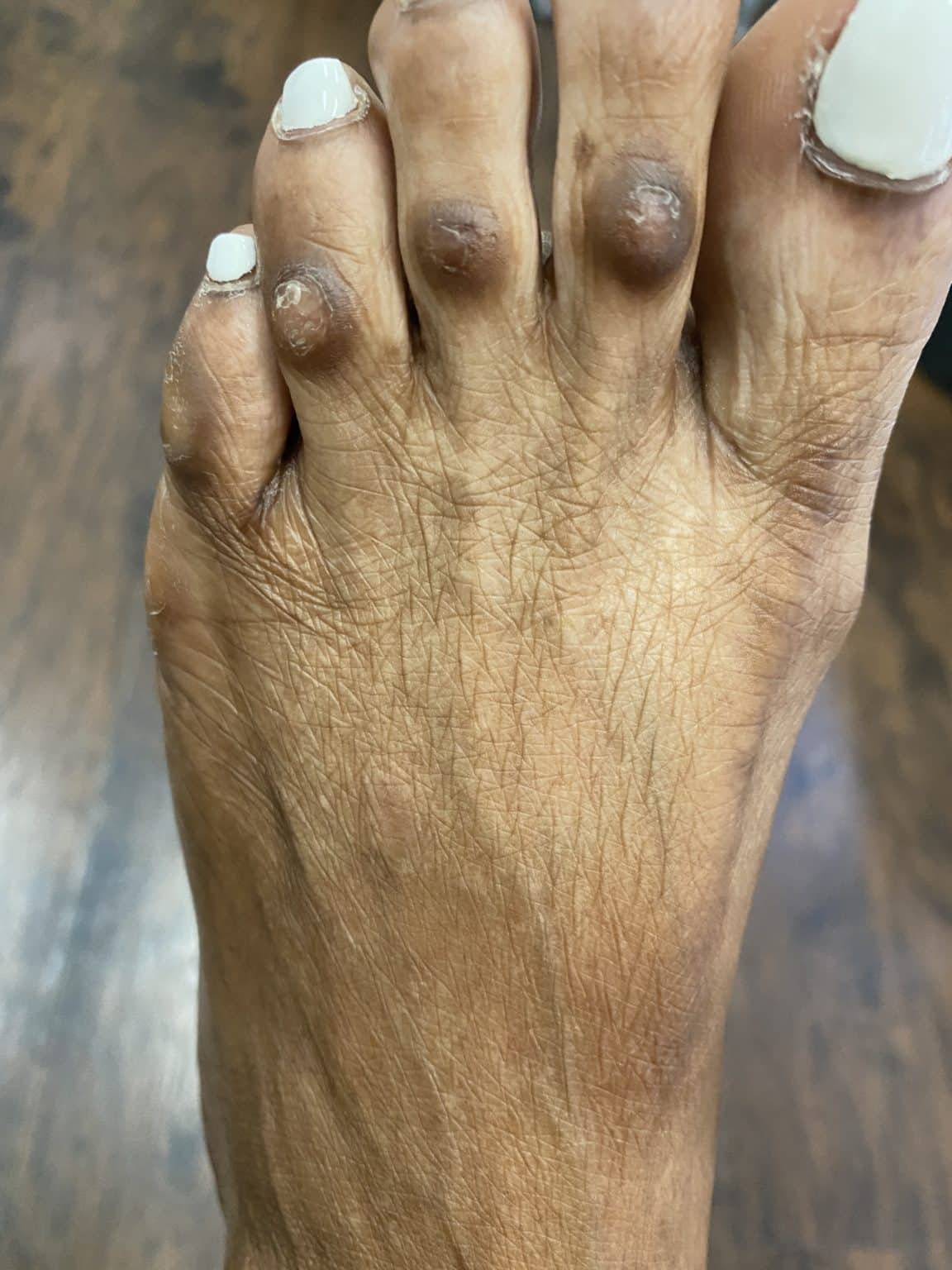Hammertoe and Corns: Diagnosis and Treatment in Brooklyn | NYC