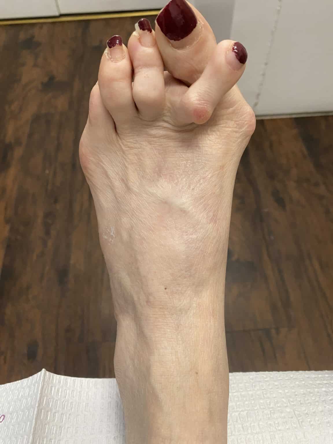 Hammertoe and Corns: Diagnosis and Treatment in Brooklyn | NYC