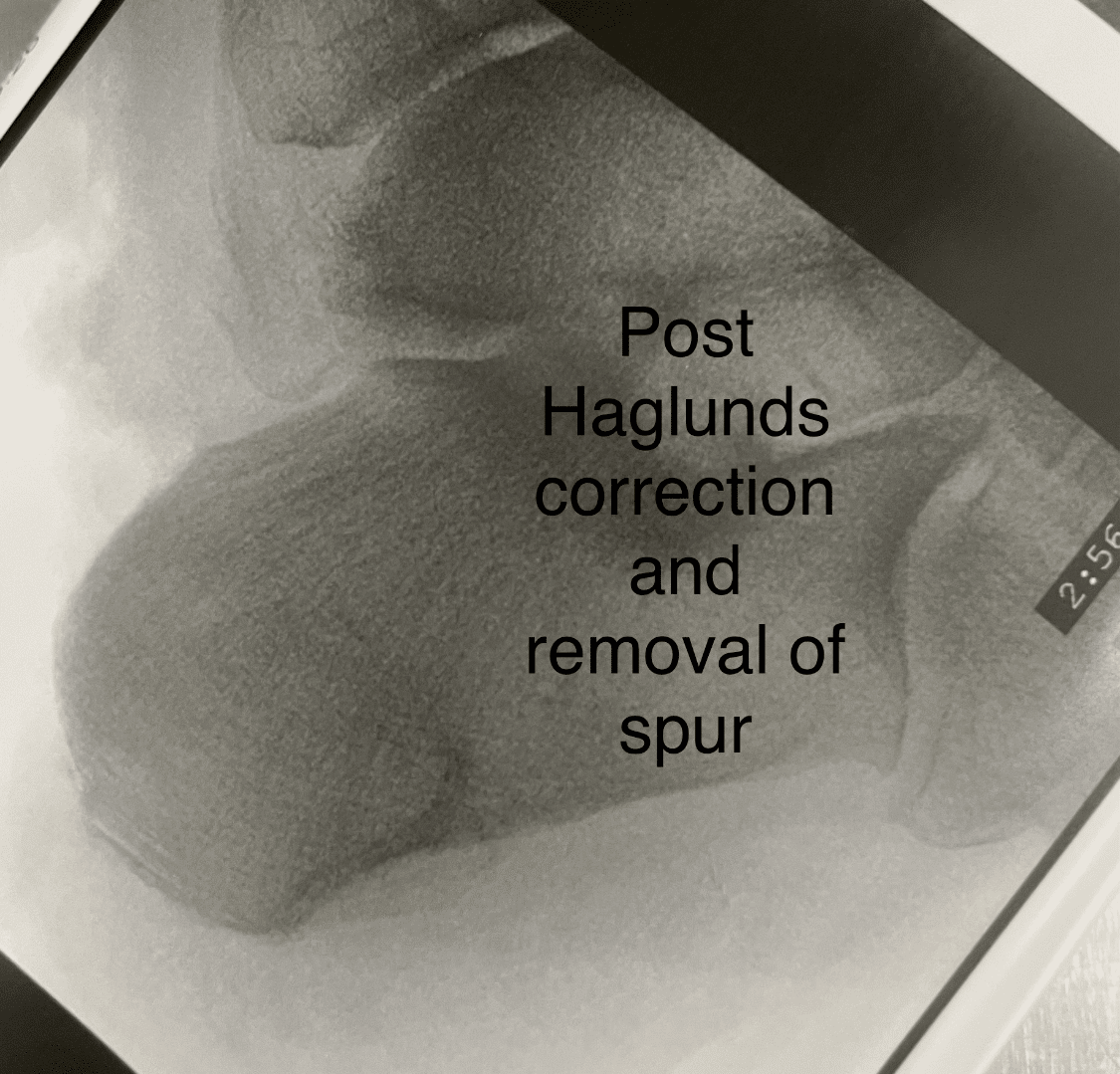 Can Achilles Tendon Surgery Treat Haglund's Syndrome?
